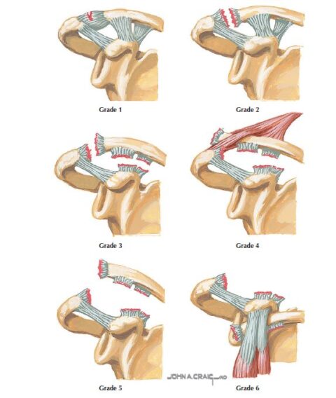 AC joint separation - Stine Chiropractic